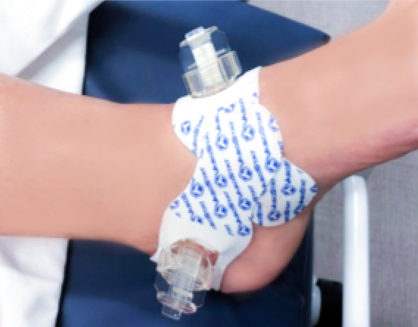 Forge Medical & VasoStat Hemostasis Device